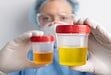 Colore delle urine: indicatore di benessere urologico spiegato qui
