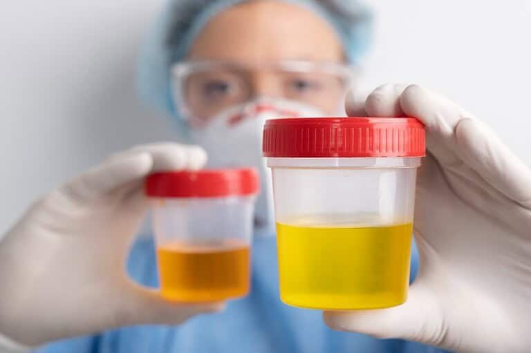 Colore delle urine: indicatore di benessere urologico spiegato qui